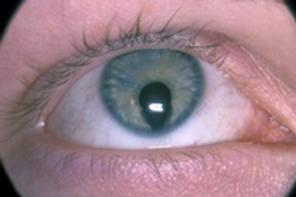 Nederlands Centrum Jeugdgezondheid | 1. Ontwikkeling oog en visuele ...