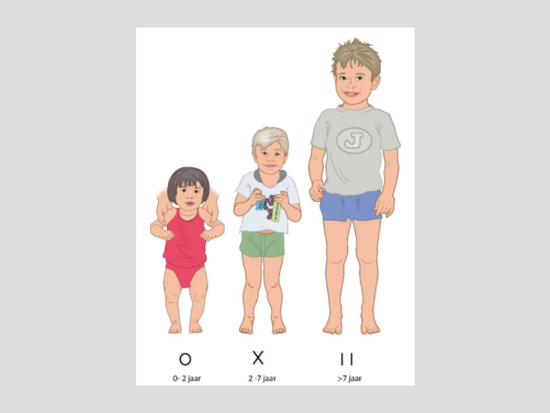 2.3.5 O-benen (genua vara) en X-benen (genua valga) - Nederlands ...